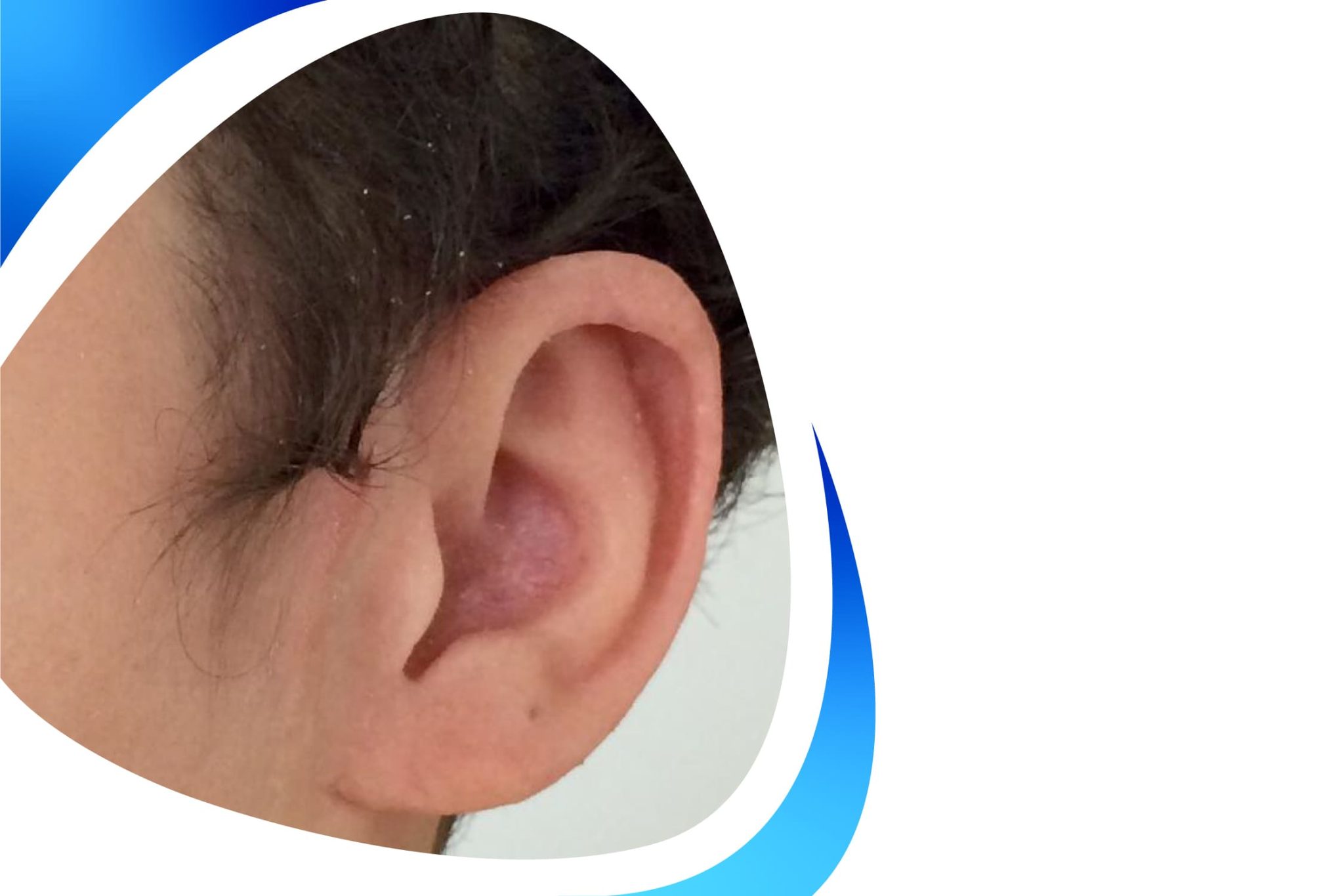 Prótesis de Oreja en Colombia